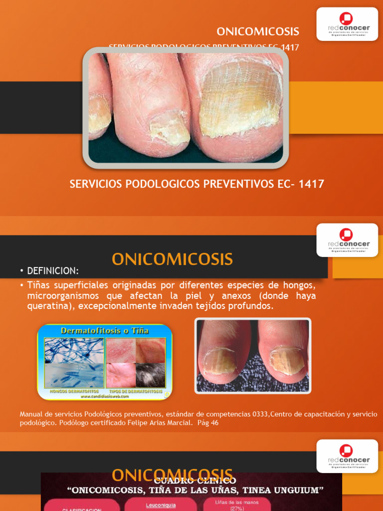 Onicomicosis: Definición y Tratamiento | PDF | Clavo (anatomía ...