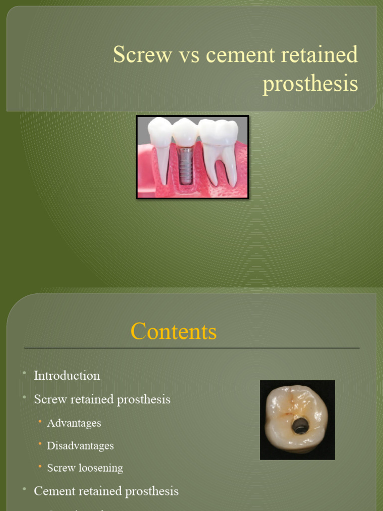 Screw Retained Vs Cement Retained Prosthesis | PDF | Dental Implant ...