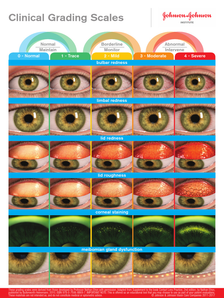 Escalas de Efron | Download Free PDF | Cornea | Contact Lens