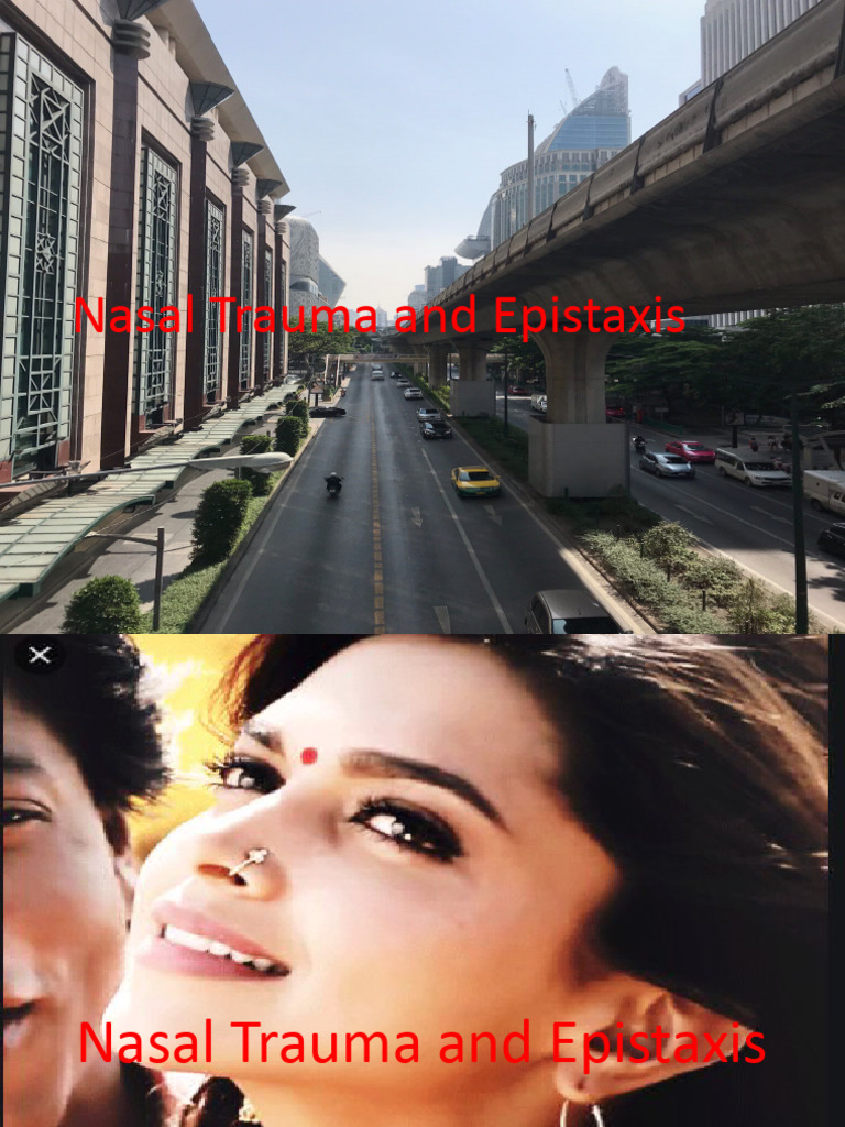2019, Nasal Trauma and Epistaxis | PDF | Human Nose | Diseases And ...