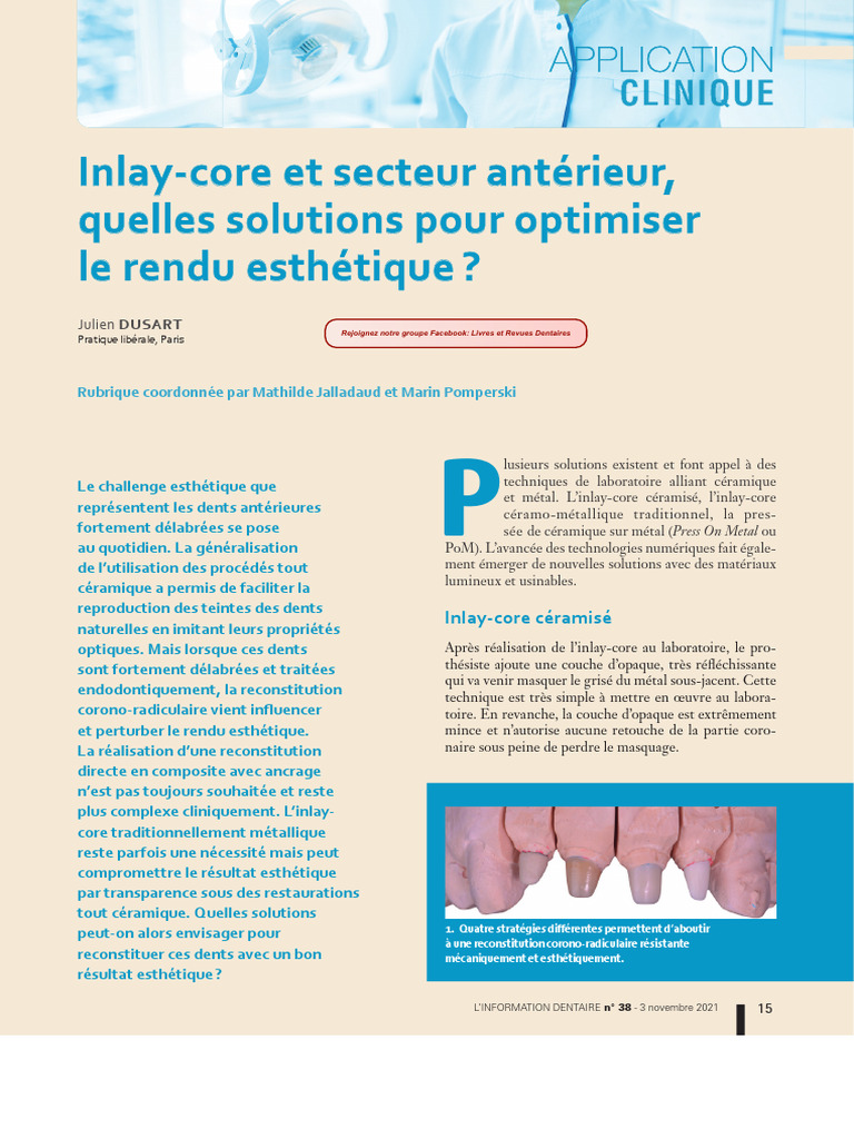 Solutions Esthétiques pour Inlay-Core | PDF | Métaux | Matériaux
