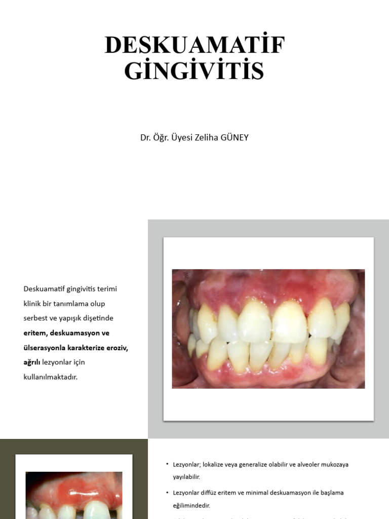 Desquamatif Gingivitis | PDF