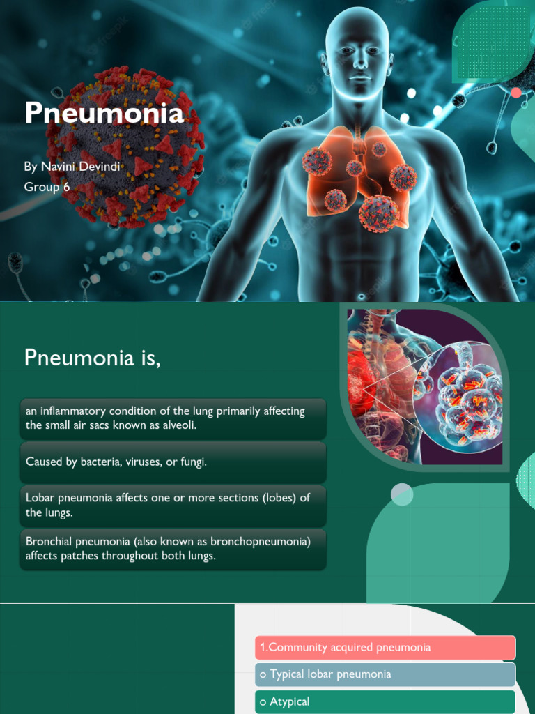 Pneumonia PPT New | PDF | Pneumonia | Influenza