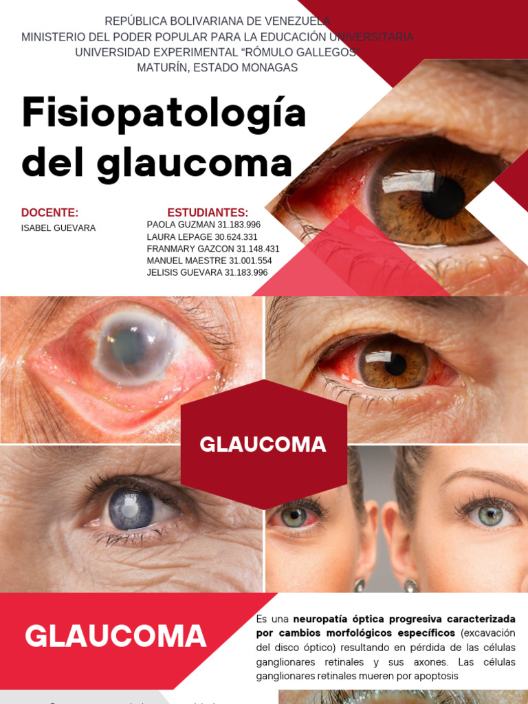 GLAUCOMA Oftalmología | PDF | Glaucoma | Ojo humano