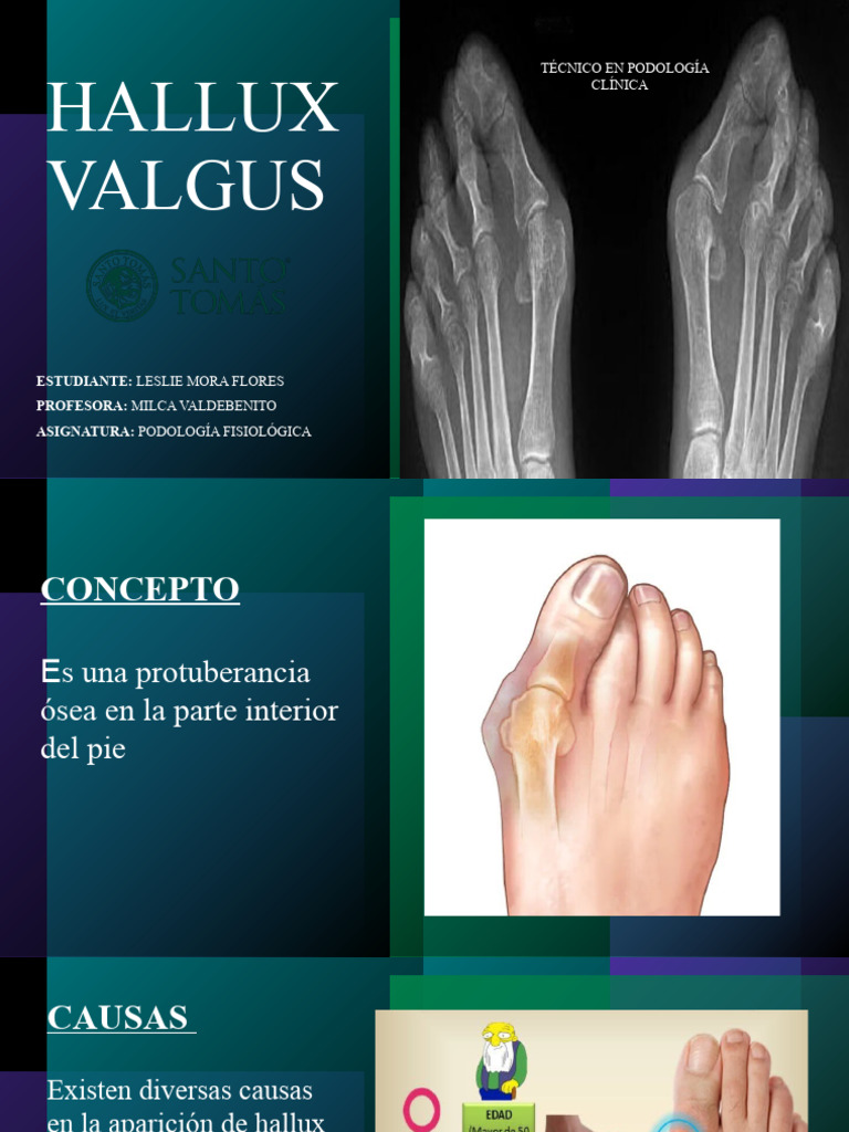 Hallux Valgus | PDF