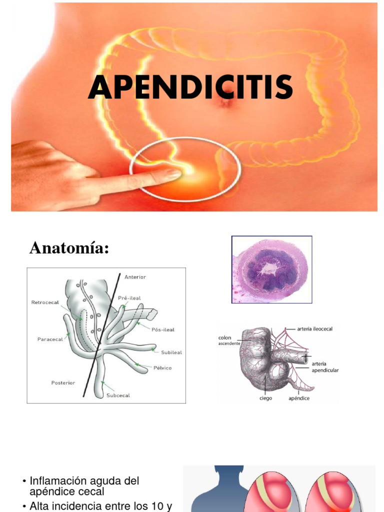 Apendicitis Cirugia | PDF | Causas de la muerte | Medicina