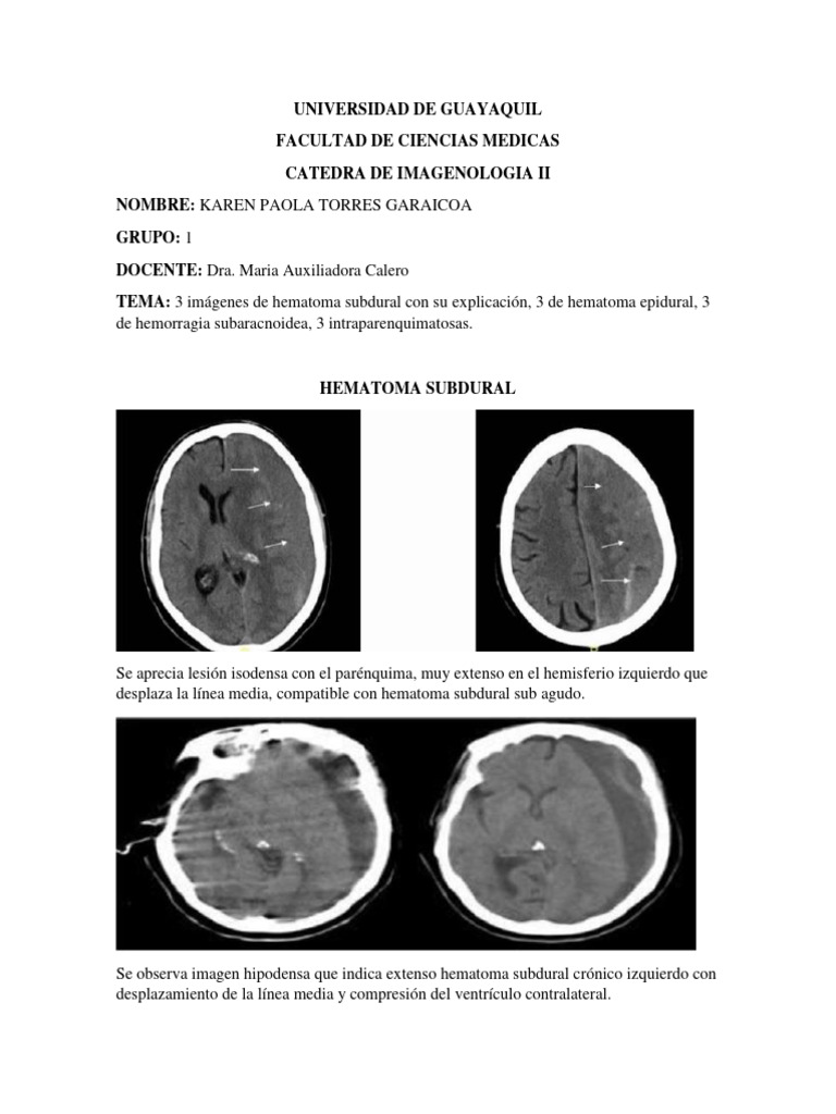 3 imágenes de hematoma subdural con su explicación, 3 de hematoma ...