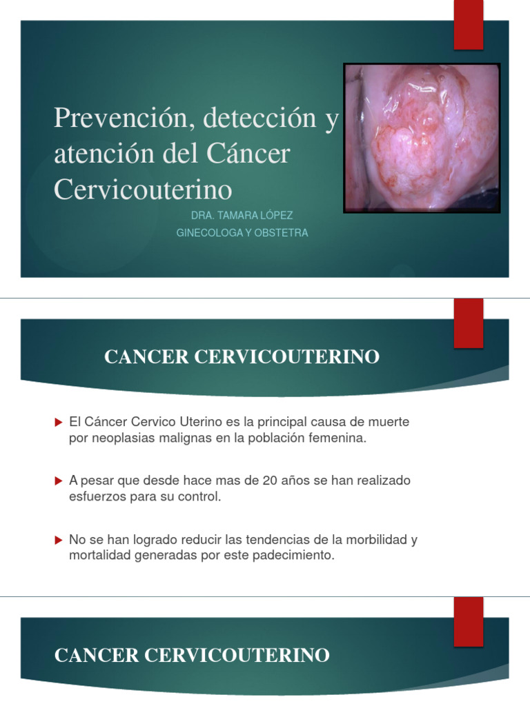 Cancer Cervicouterino 21 | PDF | Cáncer de cuello uterino ...