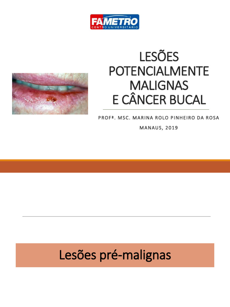 LesÃ Es Pre Malignas e Cancer Bucal 2 | PDF | Câncer | Carcinoma