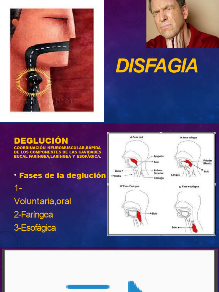 DISFAGIA | PDF | Medicina CLINICA | Especialidades Medicas