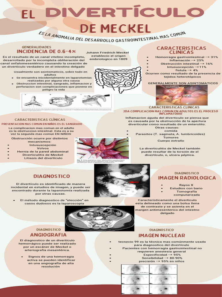Diagnóstico y manejo del divertículo de Meckel | PDF | Enfermedades y ...