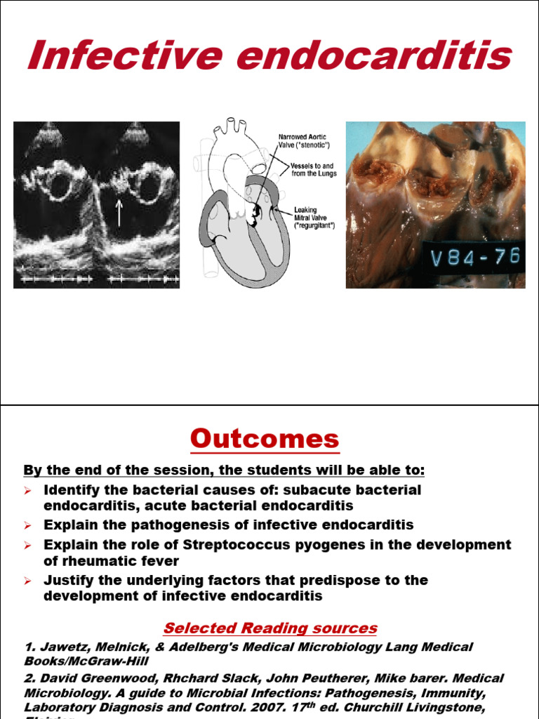 Infective Endocarditis-2023 | PDF | Streptococcus | Immunology