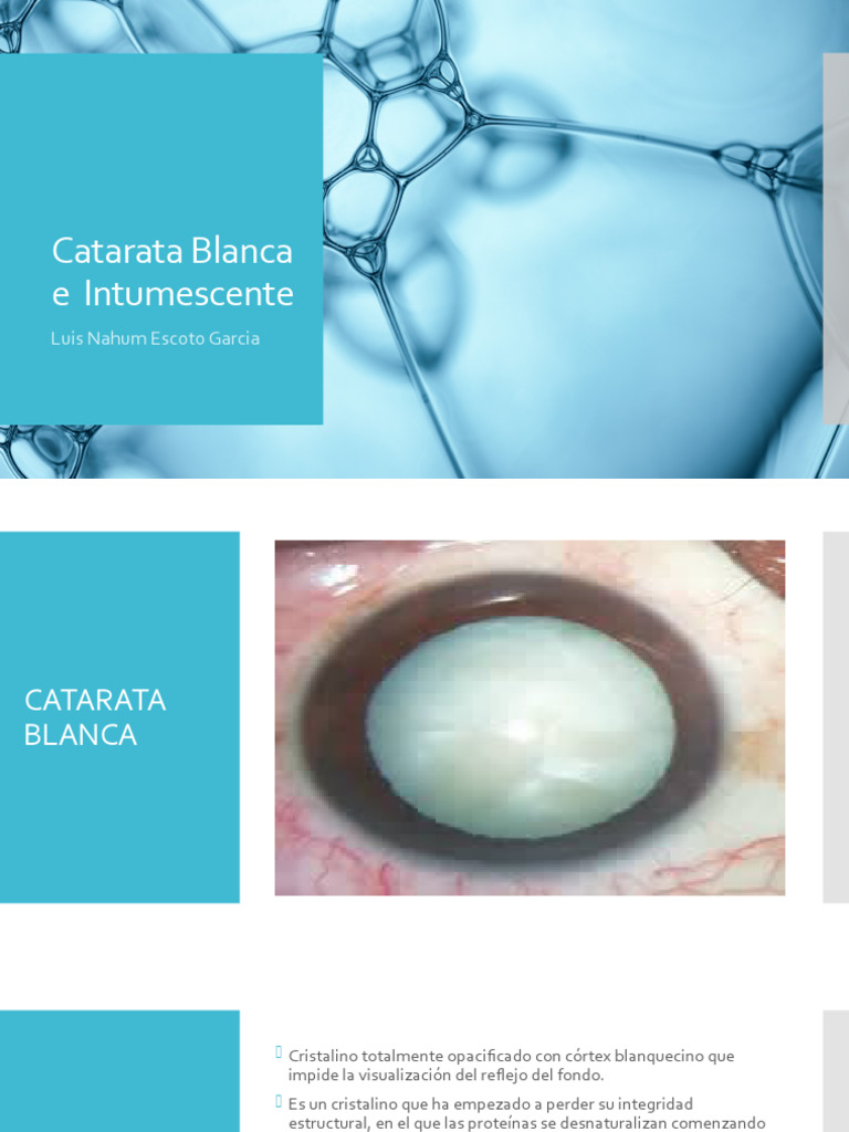 Cirugía de Catarata Blanca Intumescente | PDF | Catarata | Glaucoma