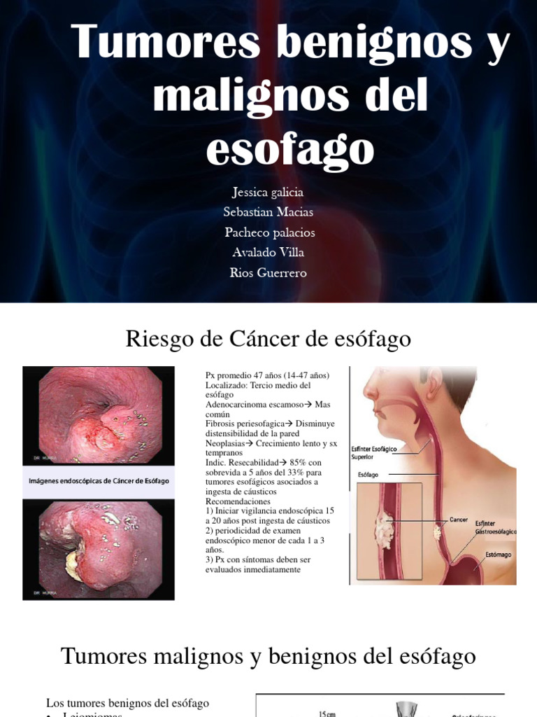 Tumores de Esofago. Gastro | PDF | Cáncer | Esófago