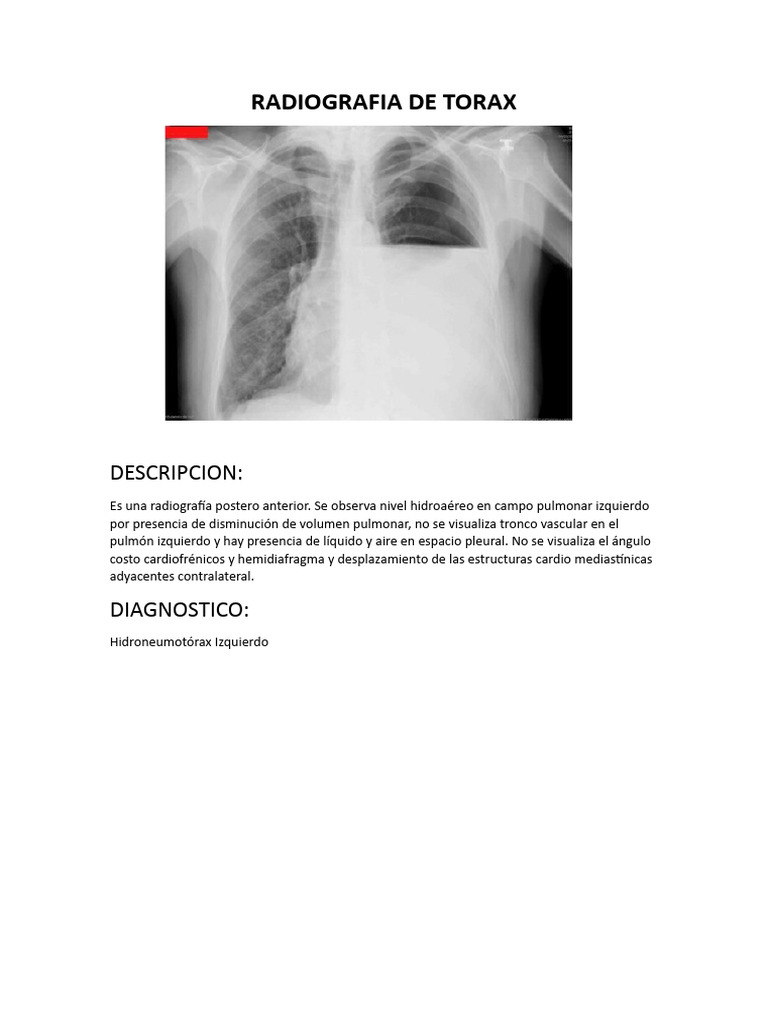 Radiografia De Torax Pdf