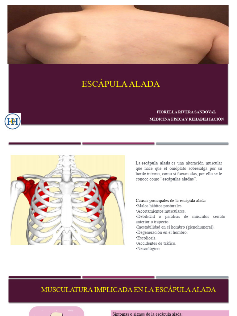 Causas y síntomas de la escápula alada | PDF | Hombro | Sistema ...