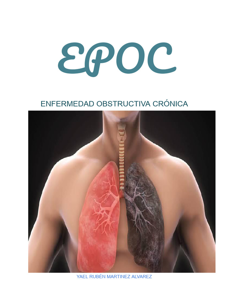 EPOC | PDF | Enfermedad pulmonar obstructiva crónica | Ct Scan