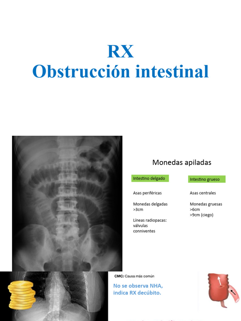 Signos Radiológicos de Obstrucción Intestinal | PDF