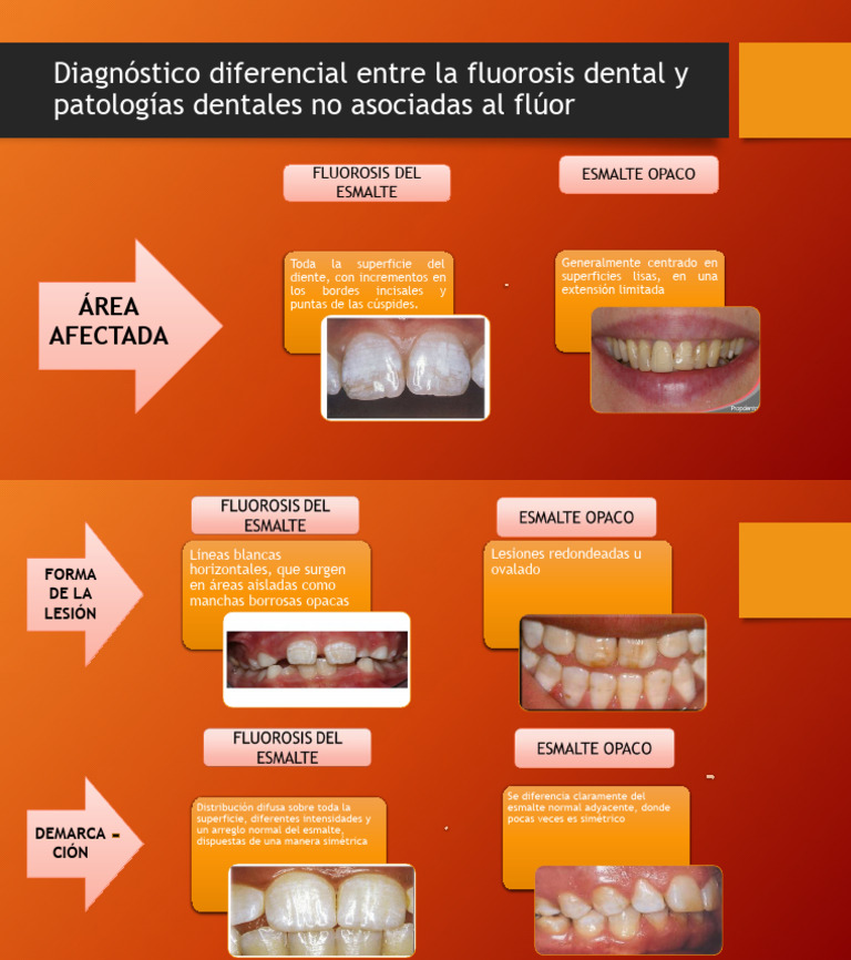 Diagnóstico Diferencial Entre La Fluorosis Dental y Patologías | PDF