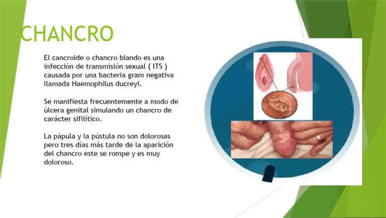 Chancroide: Síntomas y Causas | PDF