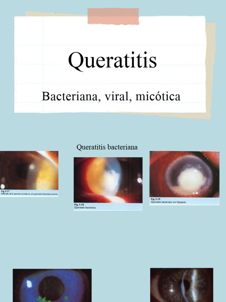 Queratitis | PDF