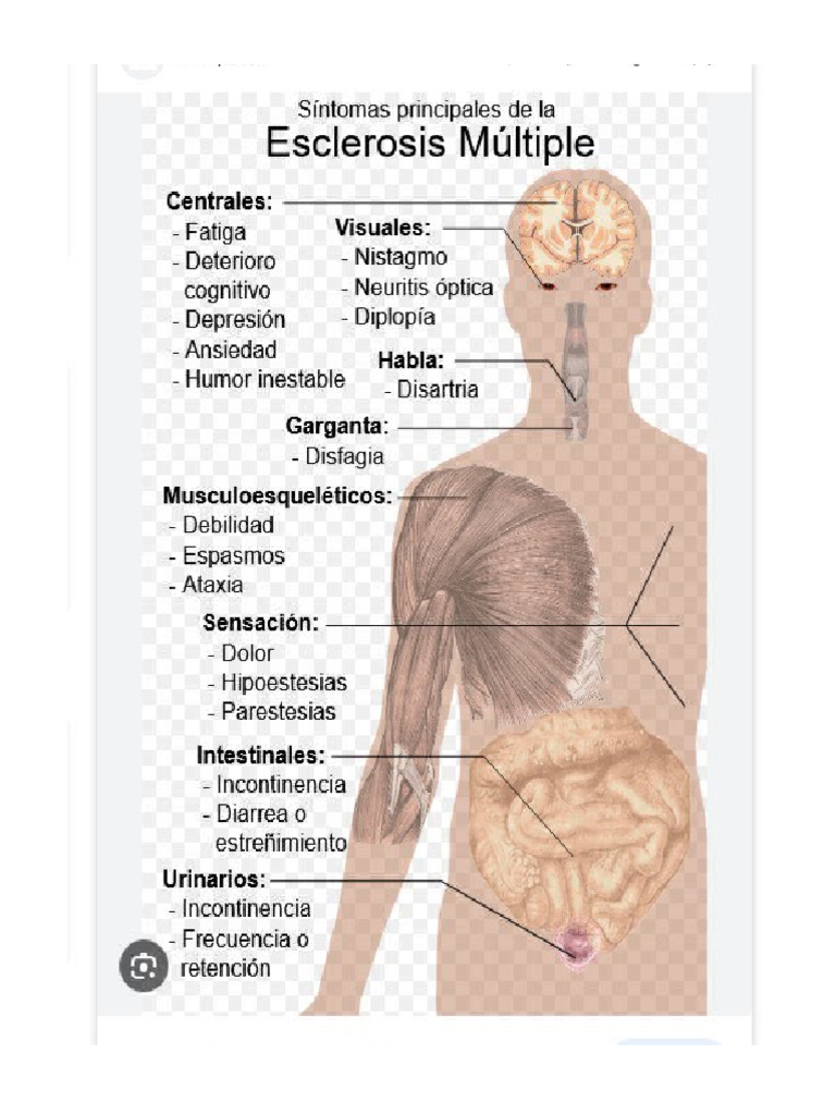 La esclerosis múltiple | PDF