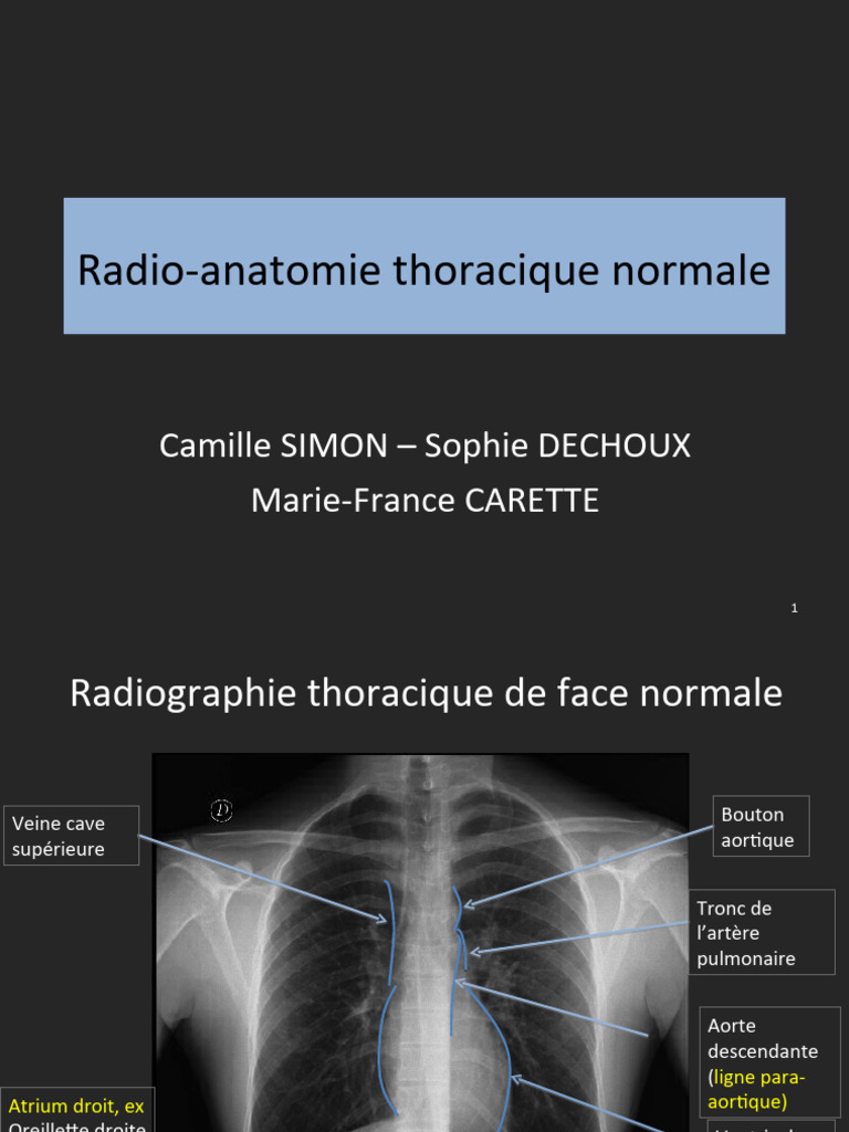 Radio Poumon Normal | PDF