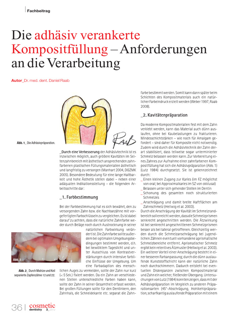 Die Adhaesiv Verankerte Kompositfuellung - Anforderungen An Die ...
