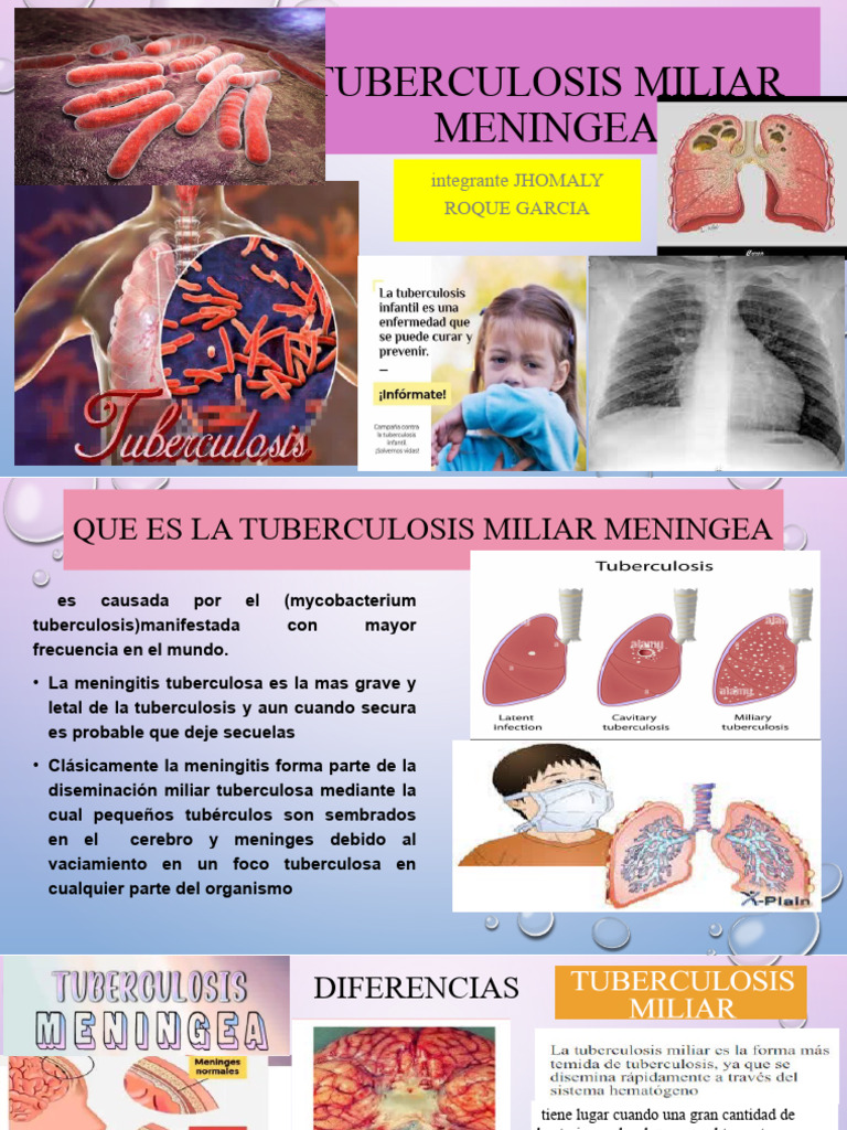 TUBERCULOSIS MILIAR MENINGEA cr (1) | PDF | Tuberculosis | Meningitis