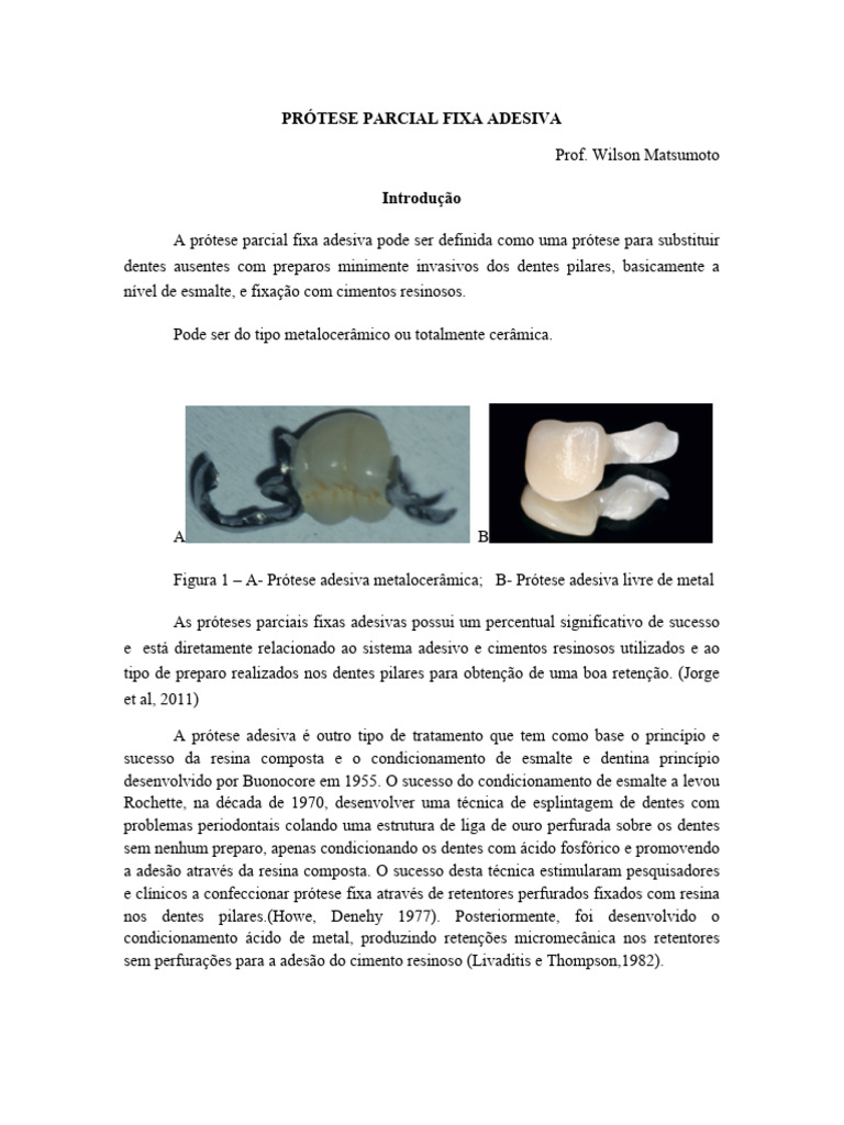 Prótese Fixa Adesiva. Maio.2020 | PDF