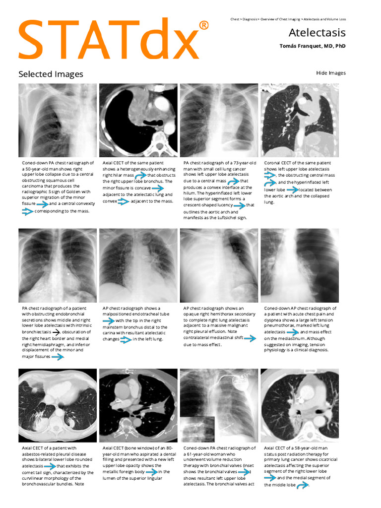 Atelectasis - Print Friendly - STATdx | PDF | Lung | Causes Of Death