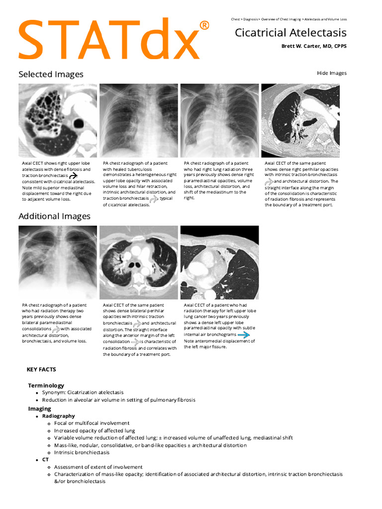 Cicatricial Atelectasis - Print Friendly _ STATdx | PDF | Respiratory ...