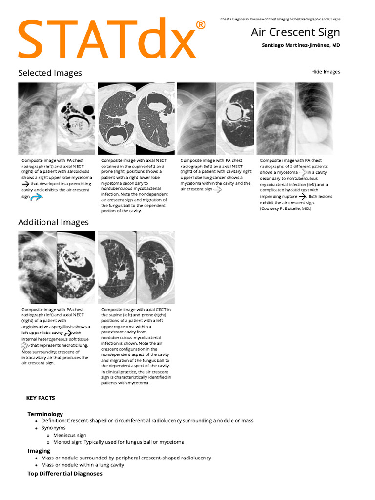 Air Crescent Sign - Print Friendly - STATdx | PDF | Clinical Medicine ...
