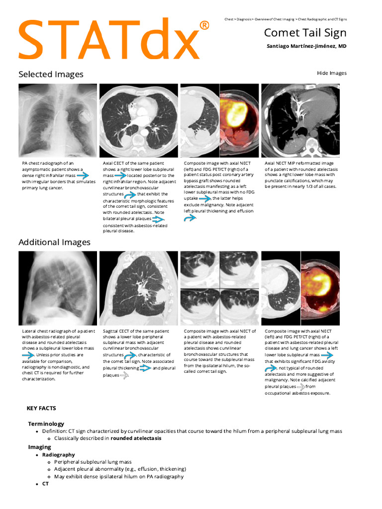 Comet Tail Sign in Chest Imaging | PDF