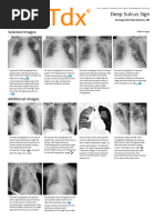 Hilum Overlay Sign in Chest Imaging | PDF