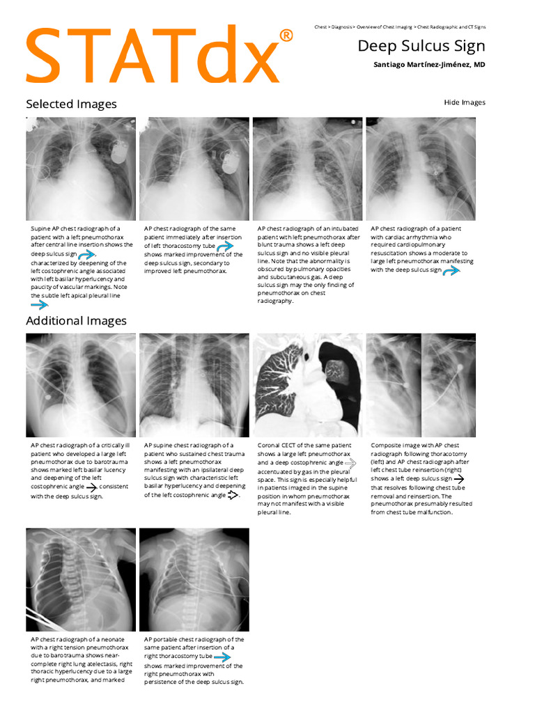 Deep Sulcus Sign - Print Friendly - STATdx | PDF | Radiography | Thorax ...