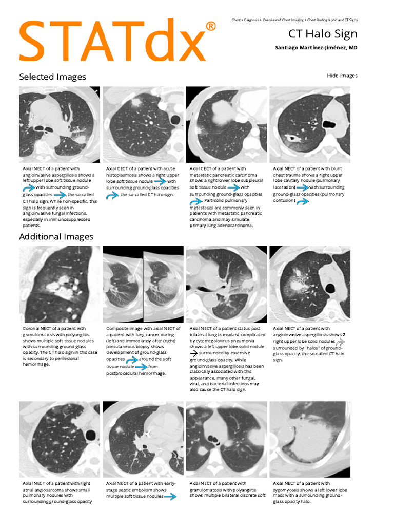 CT Halo Sign - Print Friendly - STATdx | PDF | Causes Of Death ...