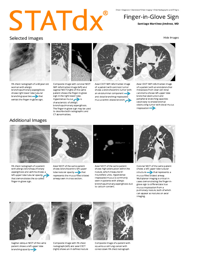 Finger-in-Glove Sign - Print Friendly - STATdx | PDF | Lung | Diseases ...