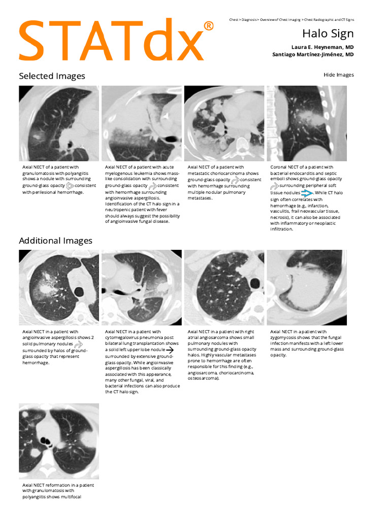 Halo Sign - Print Friendly - STATdx | PDF | Diseases And Disorders ...