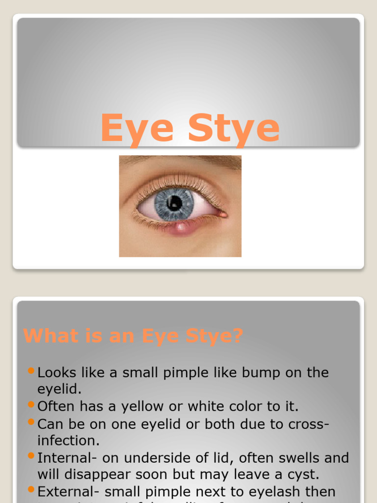 Eye Stye Cooper | PDF