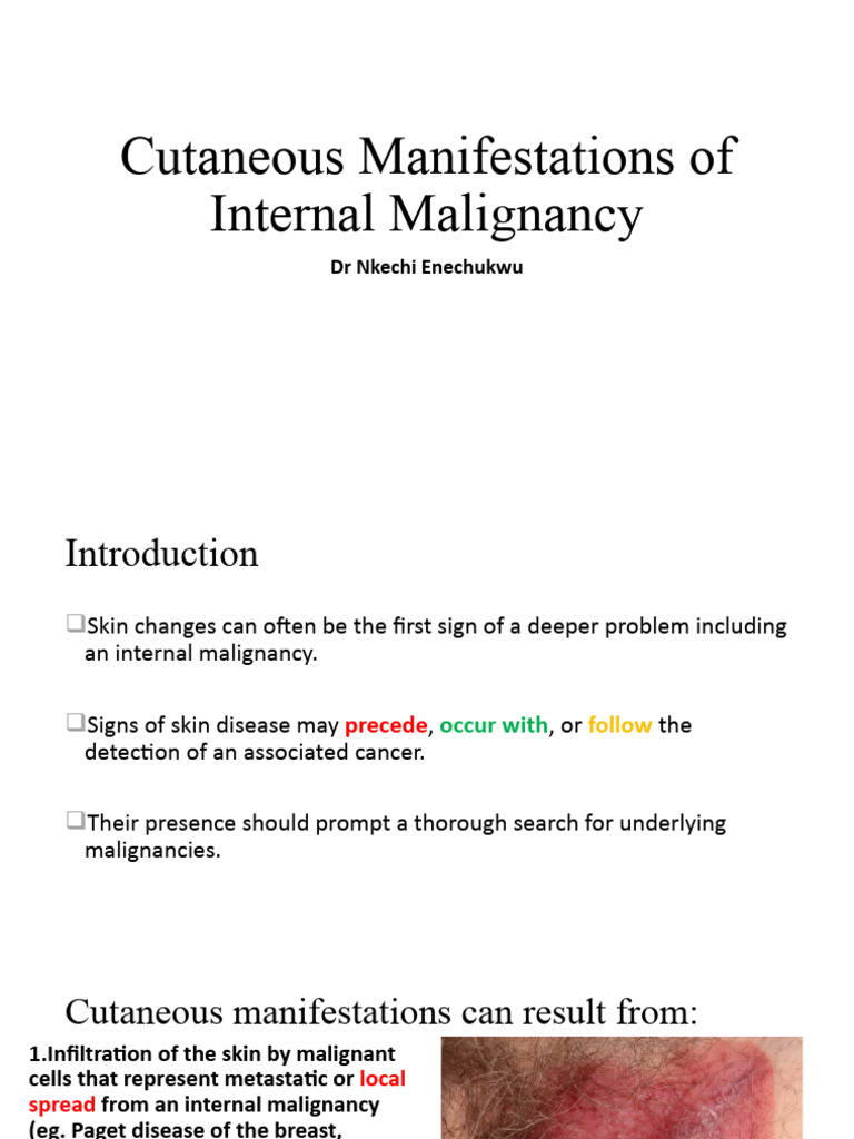 DR Enechukwu - Cutaneous Manifestations in Internal Malignancy | PDF ...