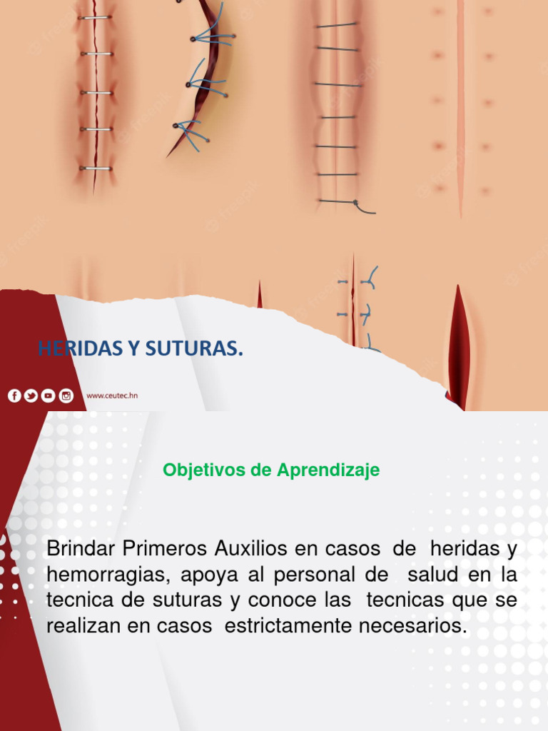 Presentación # 4 Heridas y Suturas | PDF