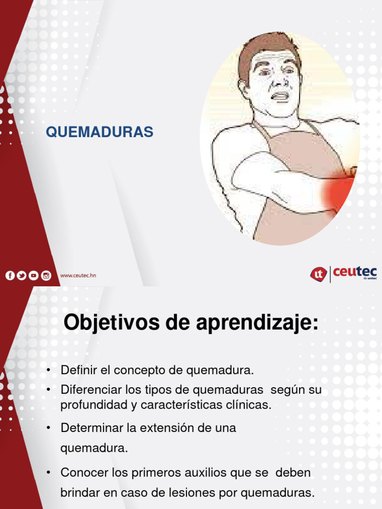 Presentación # 5 Quemaduras | PDF | Quemar | Primeros auxilios
