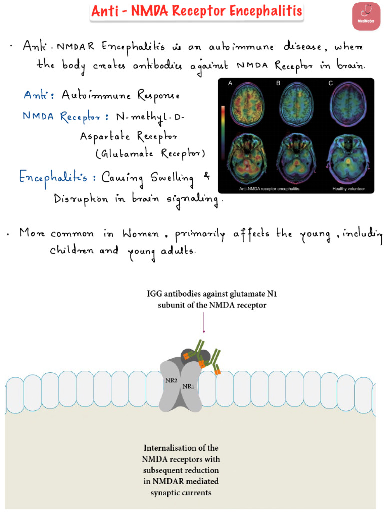 Anti - NMDA Receptor Encephalitis | PDF