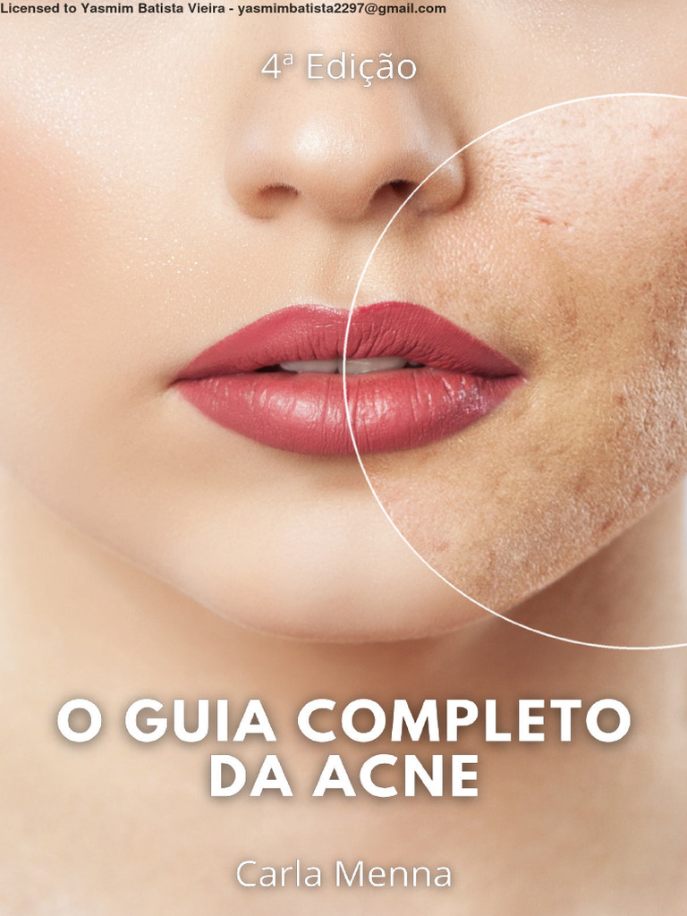 Guia Completo Da Acne Carla Menna | PDF