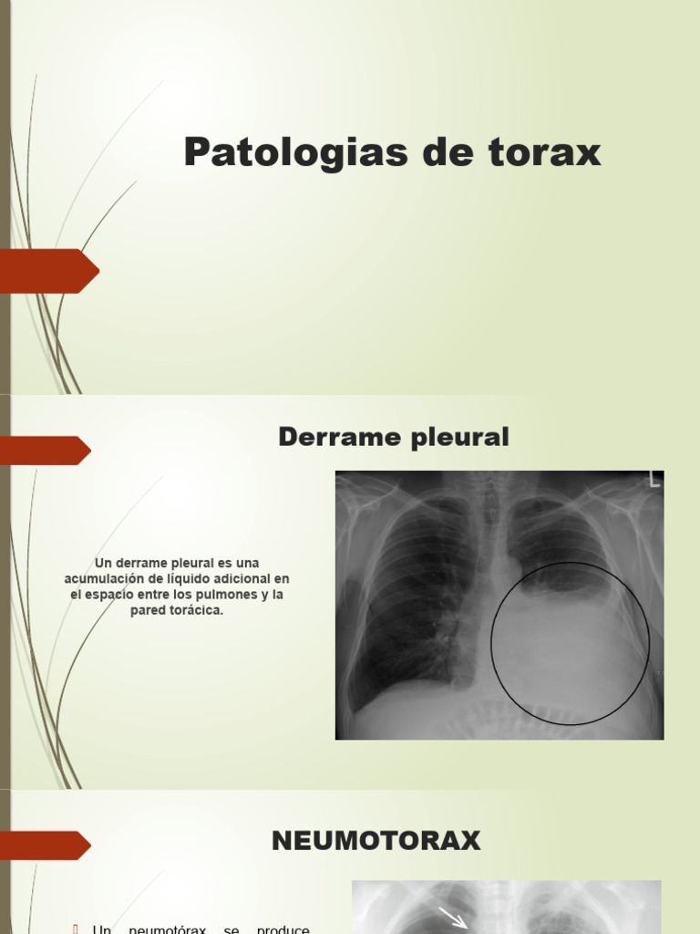 Patologías del tórax: causas y síntomas | PDF