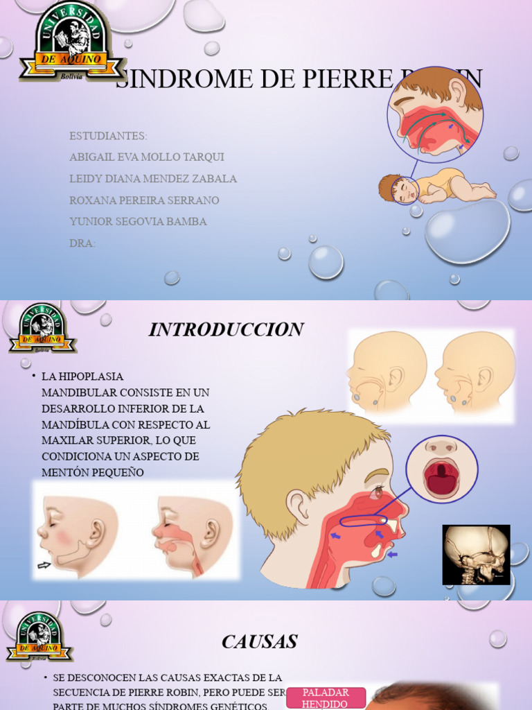 Sindrome de Pierre Robin (5' | PDF | Medicina CLINICA | Epidemiología