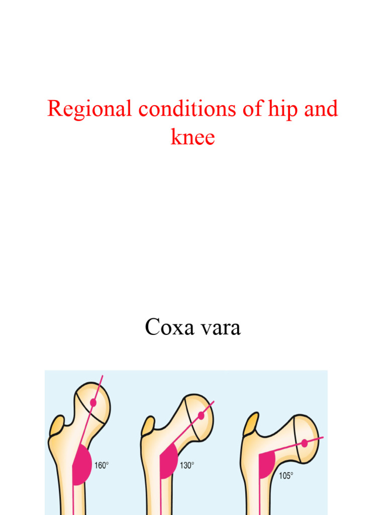 Coxa Vara and Valga: Hip Deformities Guide | PDF | Self-Improvement ...