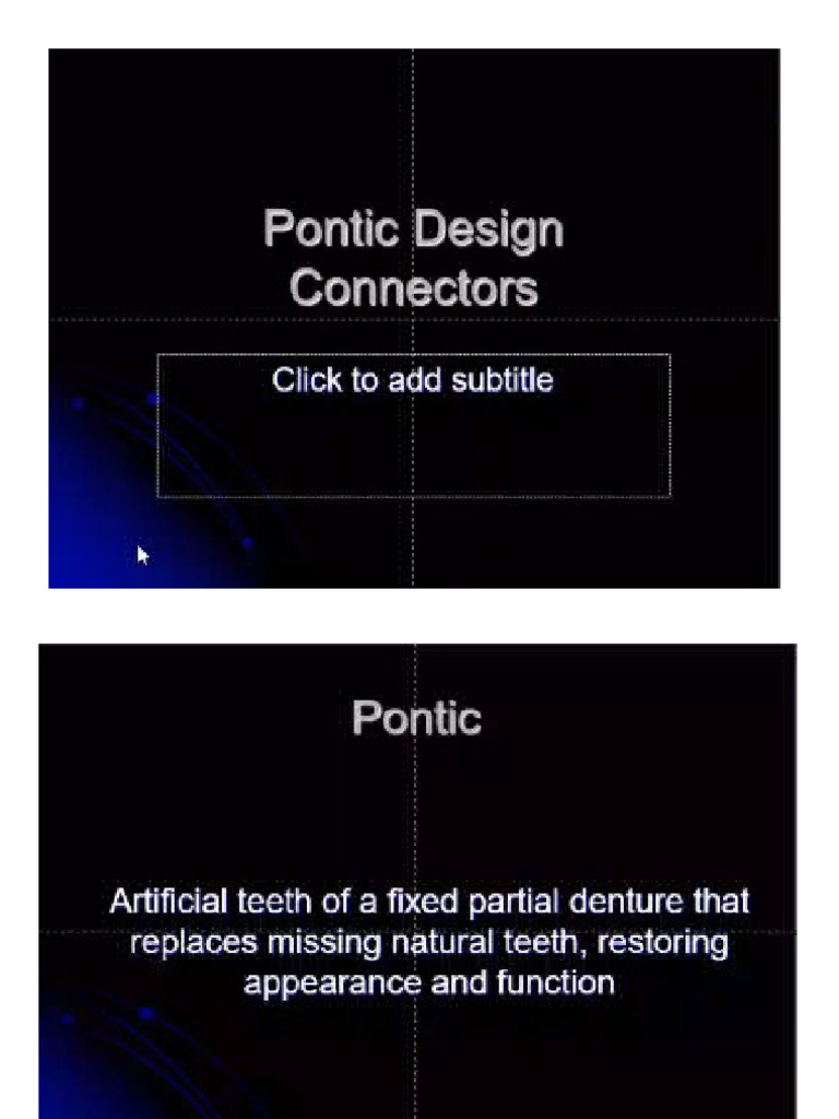 Pontic Design and Connector | PDF