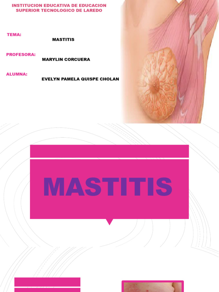 Mastitis: Síntomas, Causas y Prevención | PDF | Pecho | Salud pública